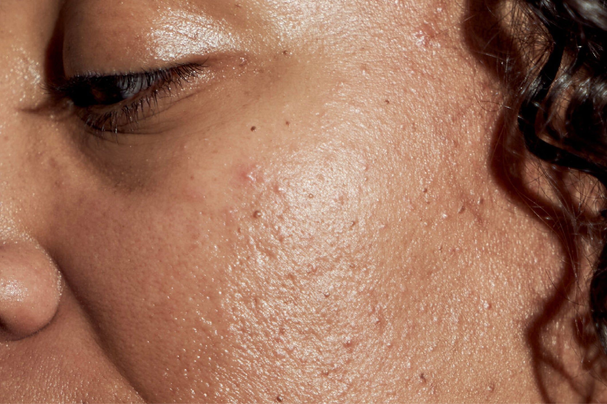 Acne: Types, Causes, Treatment, and Prevention – Foxtale