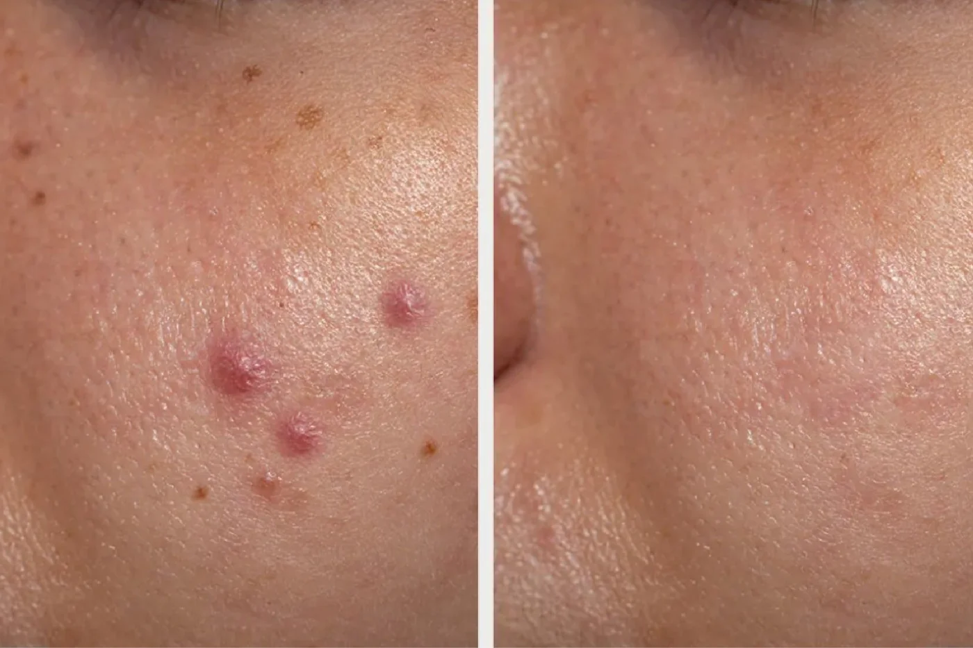 Acne vs. Acne Scars: How Niacinamide Tackles Both – Foxtale