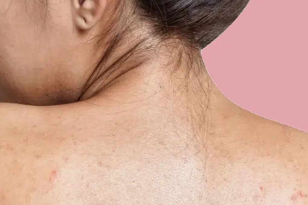 Back Acne “Bacne” Breakout? How to Treat & Prevent Back Pimples – Foxtale