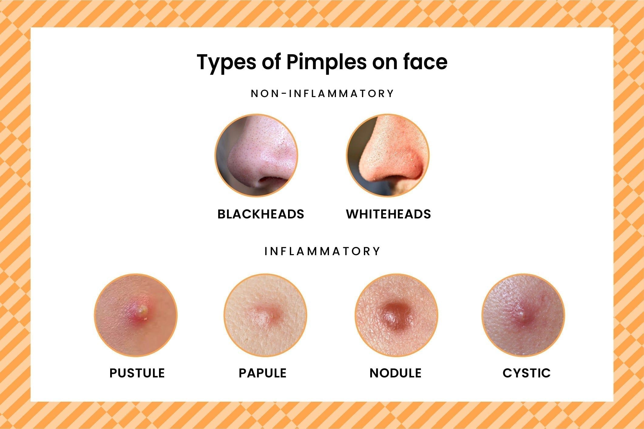 Different Types of Pimples and How to Treat Them – FoxtaleDownload the App