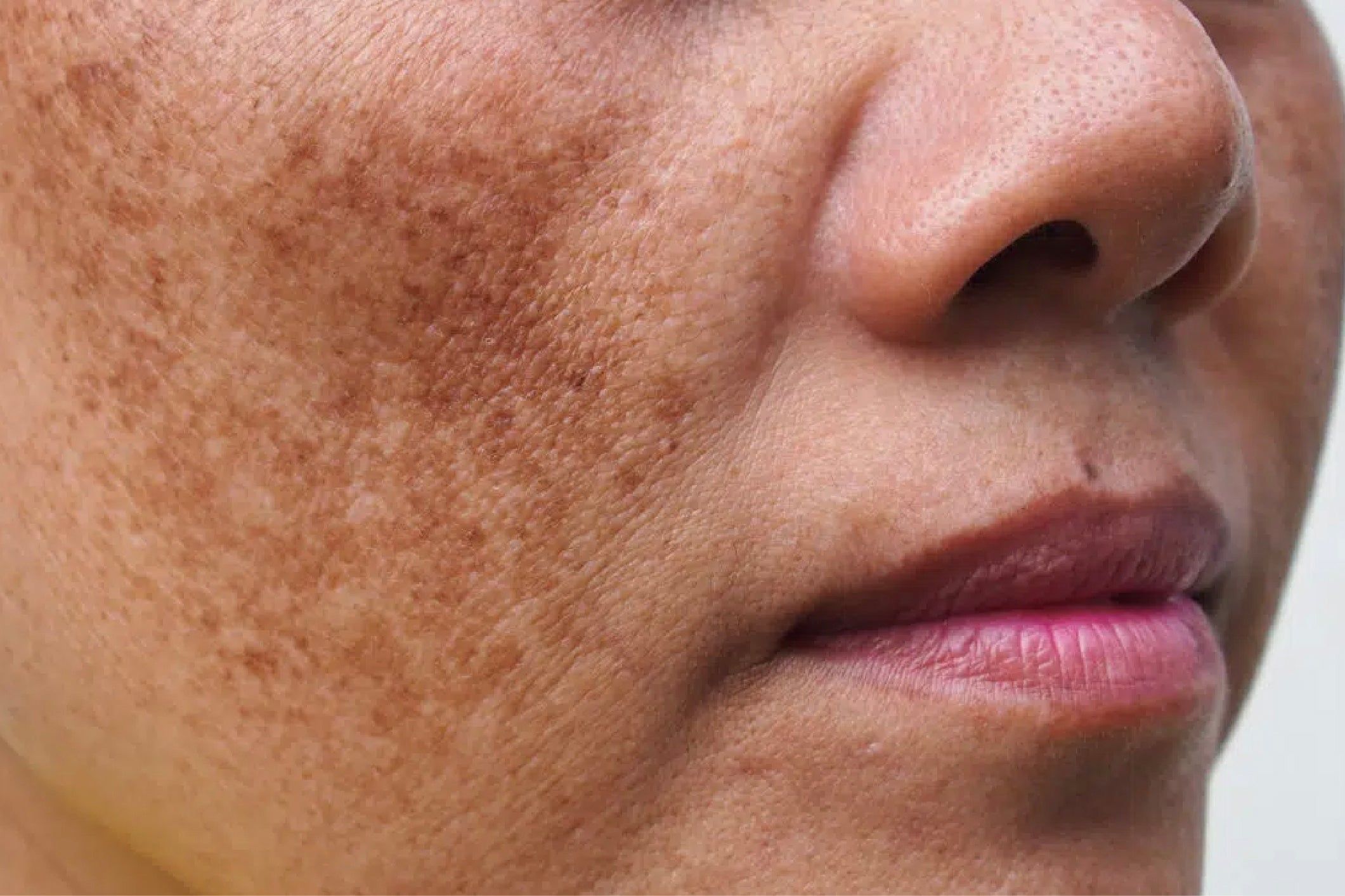 What is Post Inflammatory Hyperpigmentation: Causes, Prevention & Trea ...