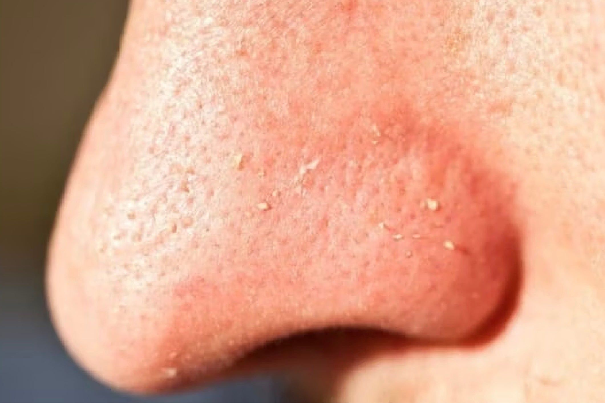 Whiteheads - Causes, Treatment, Prevention & More – Foxtale